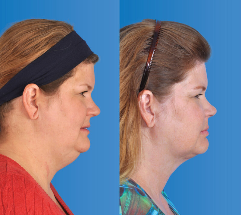 Oral Surgery Photo Gallery - DCOMS