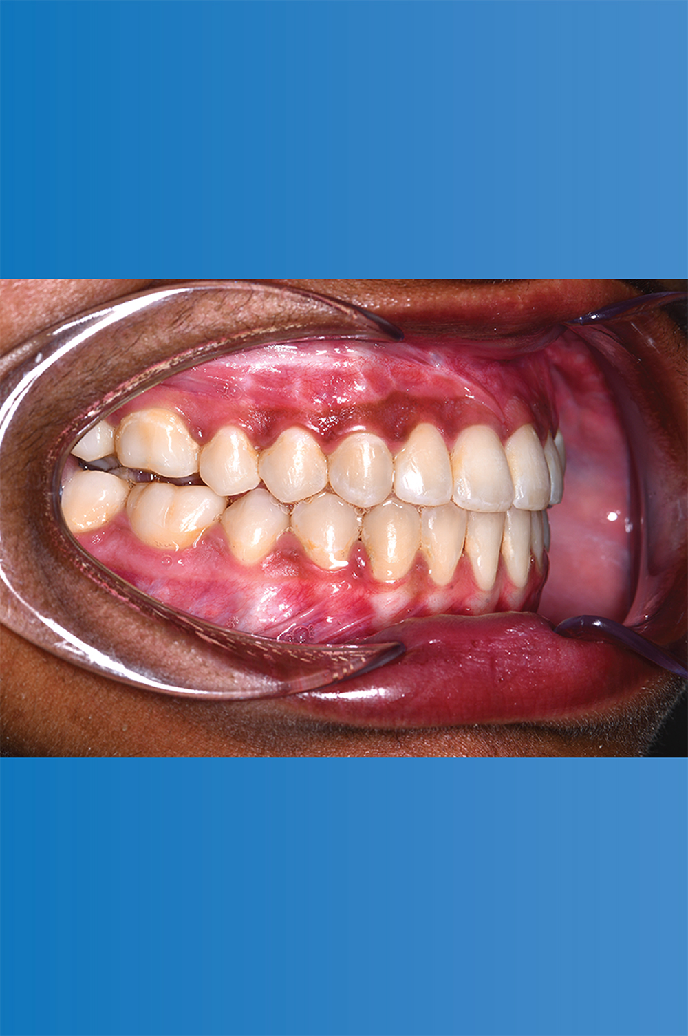 Kirthi's Jaw Surgery - DCOMS