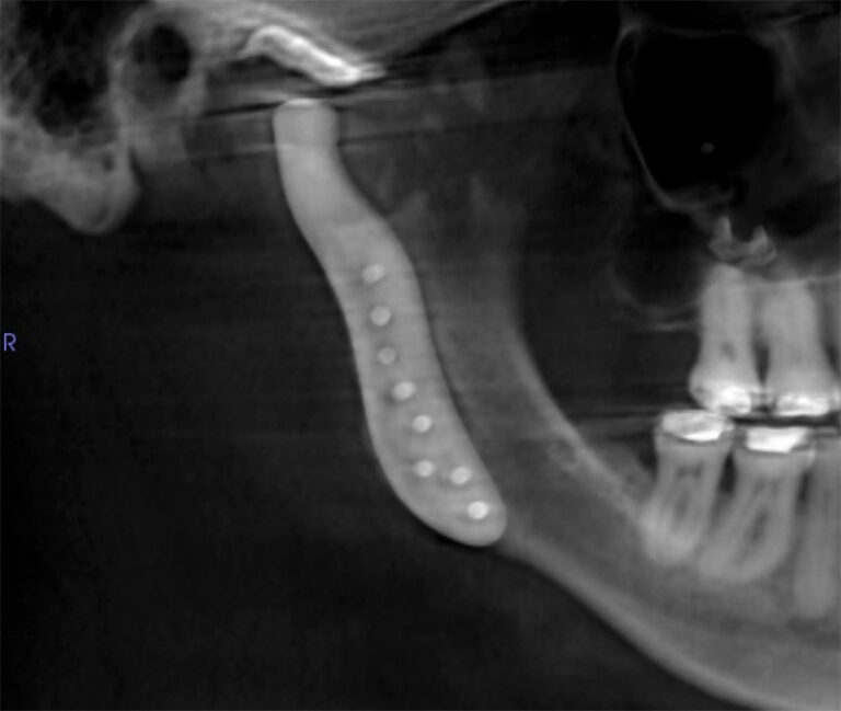 TMJ Replacement - DCOMS